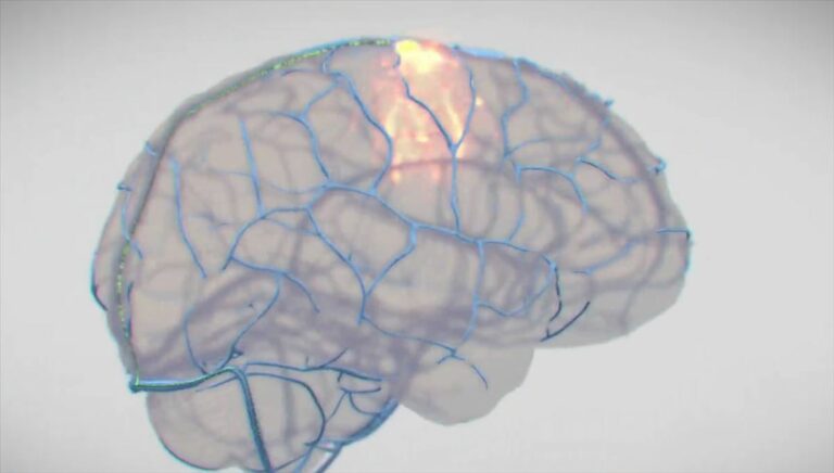 Synchron vs. Neuralink: La nueva frontera de los implantes cerebrales